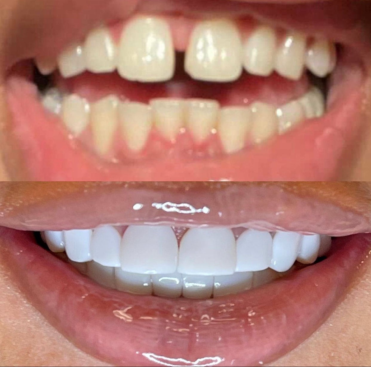 Spaced Out/Chipped Tooth | Look At My New Smile